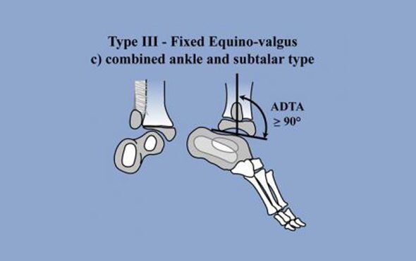 fibular hemimelia types